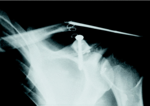 Fractura de la apófisis coracoides asociada a luxación ...