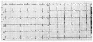 Thoracoscopic Denervation of the Left Cardiac Sympathetic Nerve to ...