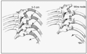 New Approaches to the Surgical Treatment of Severe Thoracic Cage ...