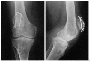 Aloinjerto masivo del aparato extensor de la rodilla | Revista Española ...
