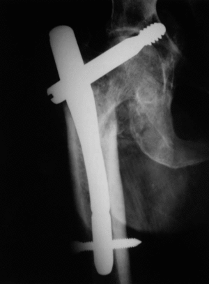 Fracturas pertrocantéreas de fémur en el anciano: clavo Gamma y clavo ...