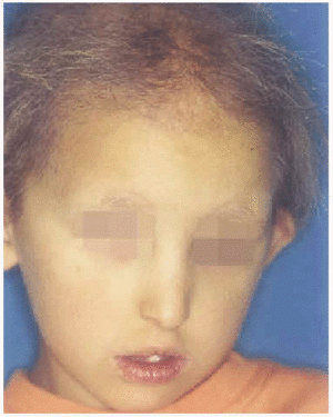 Síndrome AEC (Hay-Wells) | Actas Dermo-Sifiliográficas