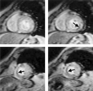 Estudio de perfusión miocárdica por cardiorresonancia magnética ...