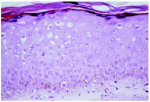 Acantoma de células grandes | Actas Dermo-Sifiliográficas
