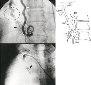 Percutaneous Closure of Complex Fistula Between the Internal Mammary ...