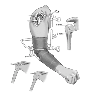 Hemiartroplastia en fracturas de la cabeza humeral | Técnicas ...