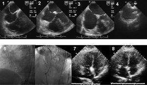Tratamiento percutáneo de los aneurismas del septo interauricular ...