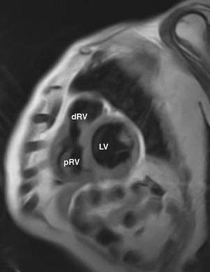 An Adult With a Double-Chamber Right Ventricle | Revista Española de ...