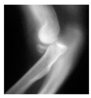 Tratamiento quirúrgico de las luxaciones del codo asociadas a fractura ...