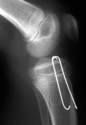 Fijación interna de avulsión de espina tibial en niños | Técnicas ...