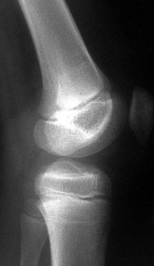 Fijación interna de avulsión de espina tibial en niños | Técnicas ...