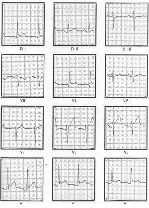 Derrame Pericárdico Ecg