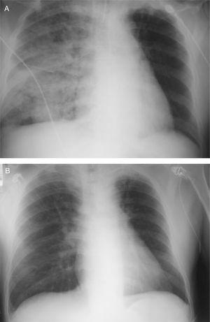 Asymmetric Pulmonary Perfusion Causing Unilateral Pulmonary Edema As a ...