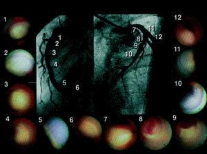 Nuevas tendencias en la evaluación de la placa vulnerable mediante ...