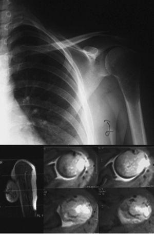 Leiomiosarcoma de húmero: un caso de dolor inespecífico de hombro ...