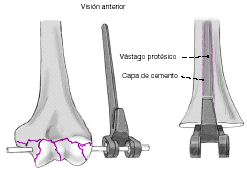 Prótesis total de codo primaria en fracturas del húmero distal ...
