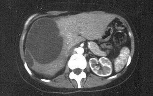 Quiste hepático endometriósico malignizado | Cirugía Española