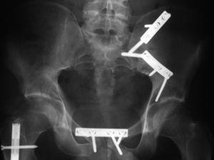 Fijación interna de la articulación sacroilíaca | Técnicas Quirúrgicas ...