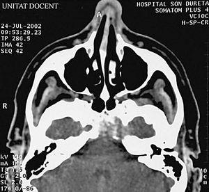 Metástasis en clivus de hepatocarcinoma asociado a quimiembolización ...