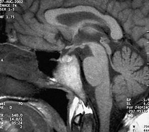 Metástasis en clivus de hepatocarcinoma asociado a quimiembolización ...
