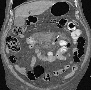 Diverticulitis yeyunal perforada | Gastroenterología y Hepatología