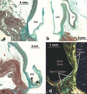 Structural Features of the Sinus of Valsalva and the Proximal Portion ...