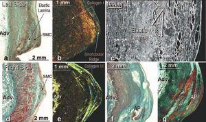 Structural Features of the Sinus of Valsalva and the Proximal Portion ...