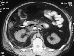 Divertículo duodenal perforado | Cirugía Española