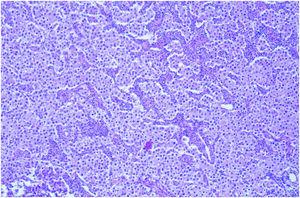 Tumores de células germinales del ovario: disgerminoma y gonadoblastoma ...