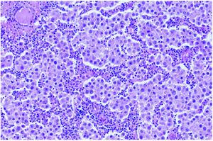 Tumores de células germinales del ovario: disgerminoma y gonadoblastoma ...