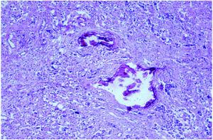 Tumores de células germinales del ovario: disgerminoma y gonadoblastoma ...