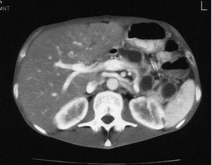 Pancreatitis aguda como presentación de una panarteritis nodular ...