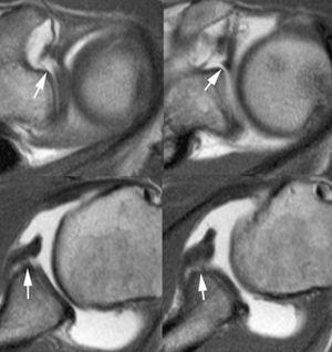 Técnica e indicaciones de la resonancia magnética artrografía ...