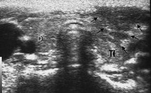 Estudio mediante técnicas de imagen de las fístulas del seno piriforme ...