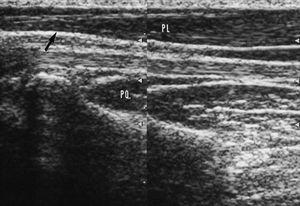 Claves para el diagnóstico ecográfico del músculo palmar largo ...