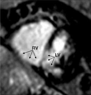 Acute Right Atrial and Ventricular Infarction | Revista Española de ...
