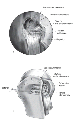 Tenodesis artroscópica de las lesiones de la porción larga del bíceps ...
