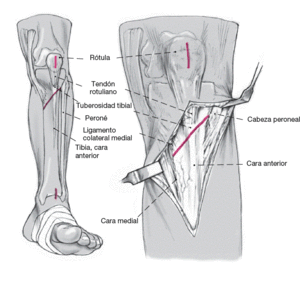 Osteotomía tibial alta oblicua de apertura para tratamiento de un genu ...