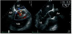 Valve Repair for Bicuspid Aortic Valve Regurgitation: An Option ...