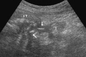 Técnicas seccionales de imagen en la enfermedad de Crohn: ecografía ...