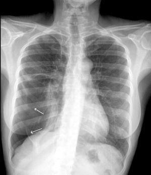 Neumotórax catamenial.Hallazgos radiológicos | Radiología