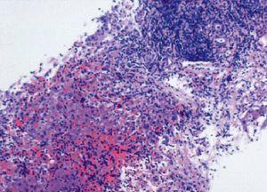 Fallo hepático agudo en un paciente con tricoleucemia ...