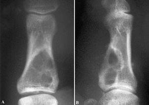 Condromas periósticos de la mano | Revista Española de Cirugía ...