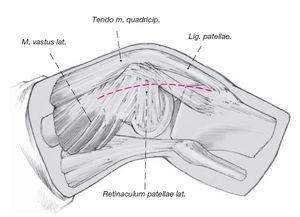 Osteotomía de apertura del cóndilo femoral lateral en inestabilidad ...