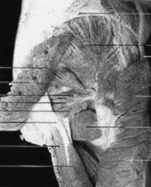 Diagnóstico y tratamiento del síndrome piriforme | Revista de la ...