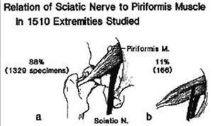 Diagnóstico y tratamiento del síndrome piriforme | Revista de la ...