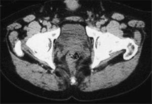 Diagnóstico y tratamiento del síndrome piriforme | Revista de la ...
