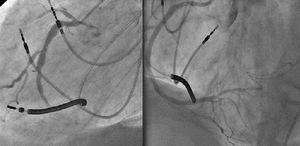 Retrograde Angioplasty in Chronic Total Occlusion | Revista Española de ...