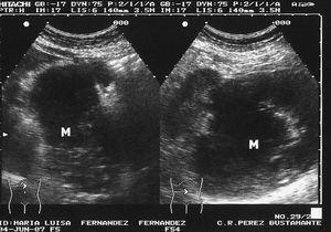 Hipernefroma, a propósito de tres casos | Medicina de Familia. SEMERGEN