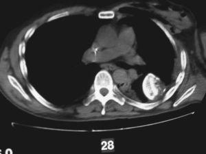 Fractura-luxación de hombro con fragmento intrapulmonar de la cabeza ...